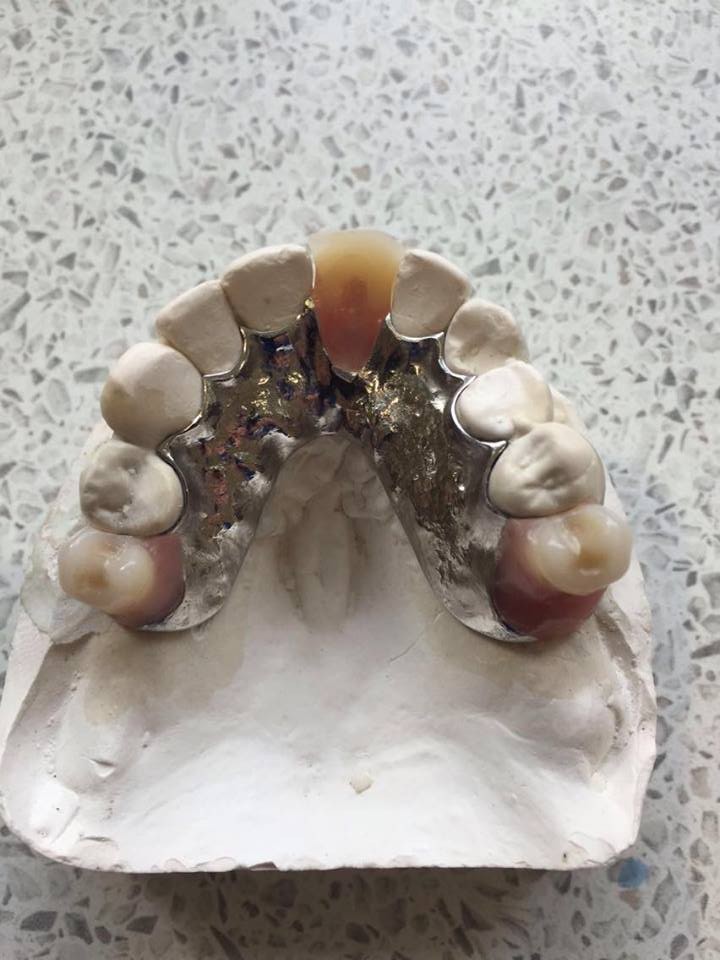 Chrome Denture | Dental Blog - Adam Norris Dental Labaratory