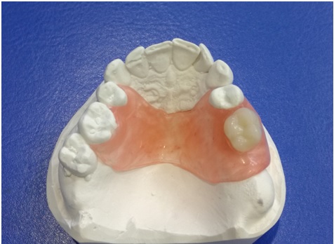 Flexible Denutre | Dental Blog - Adam Norris Dental Labaratory